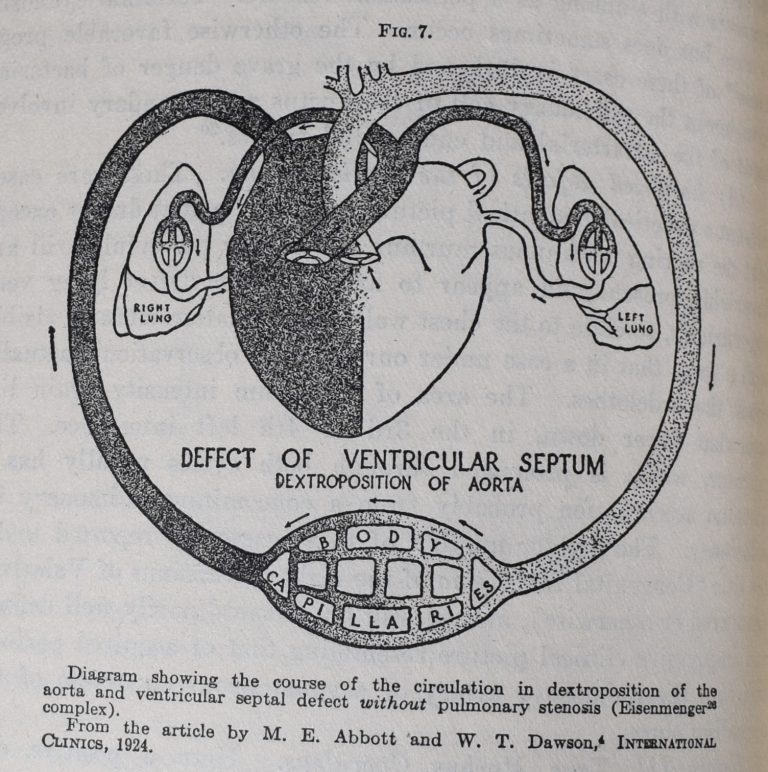Defect of the ventricular septum has been caused by dextroposition of ...